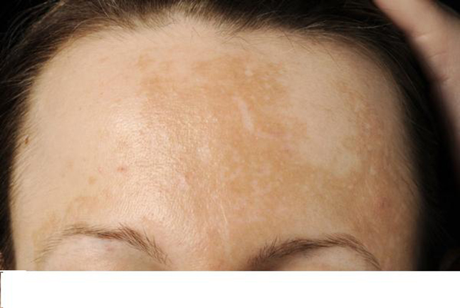 Chowdhury: Dermatology at a Glance