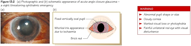 Olver: Ophthalmology at a Glance