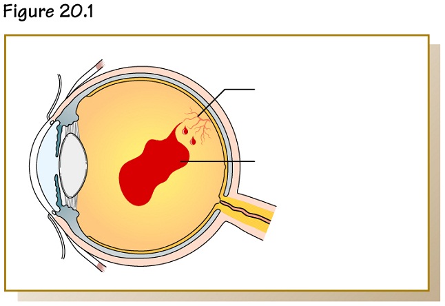 Olver: Ophthalmology at a Glance