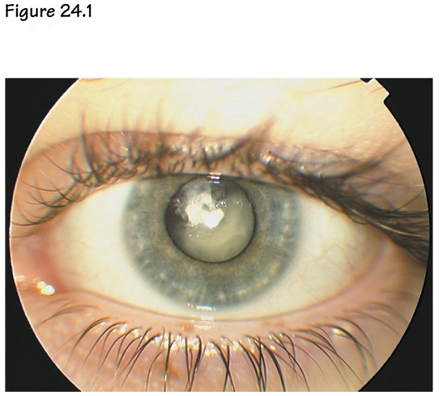 Olver: Ophthalmology at a Glance