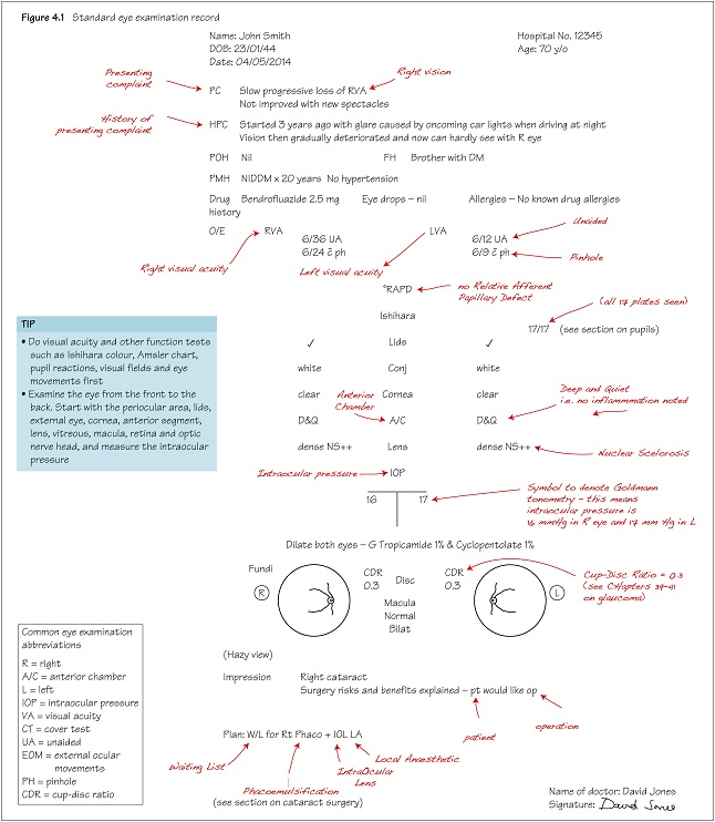 Olver: Ophthalmology at a Glance
